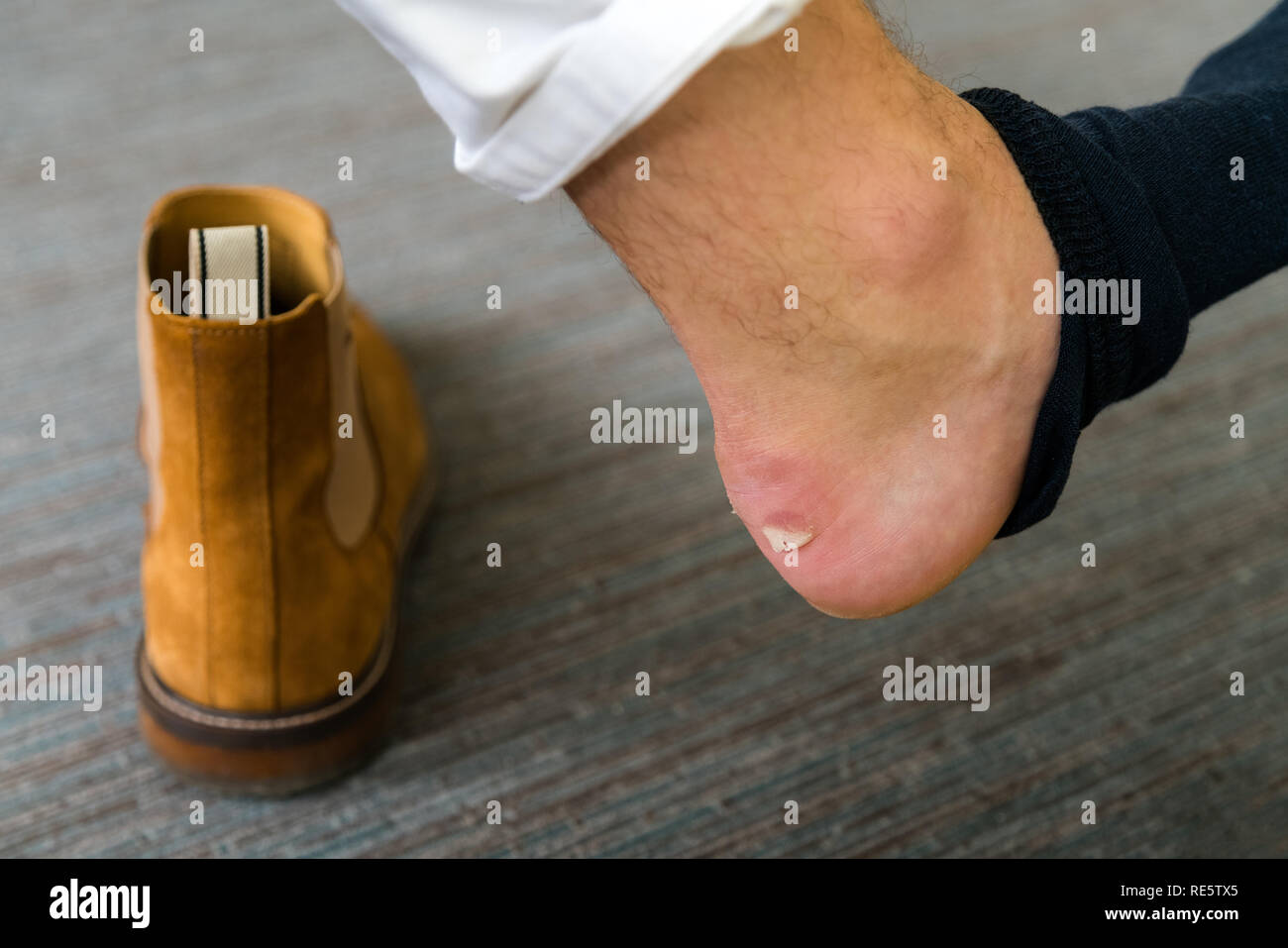 Painful Heel wound on mans feet caused by new shoes. Cracked terrible ...