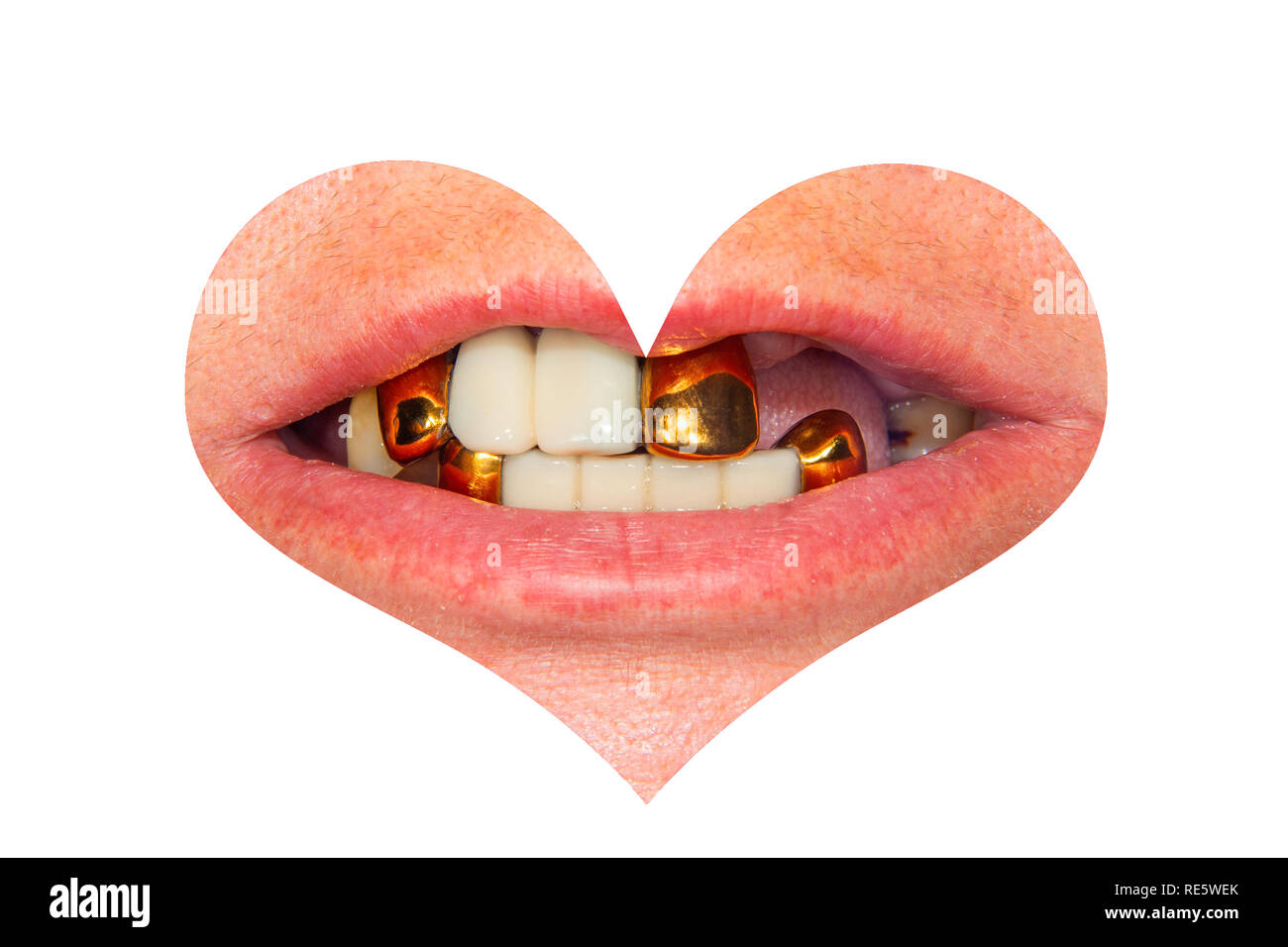 bad smile with teeth and metal dental crowns close-up in the shape of a ...