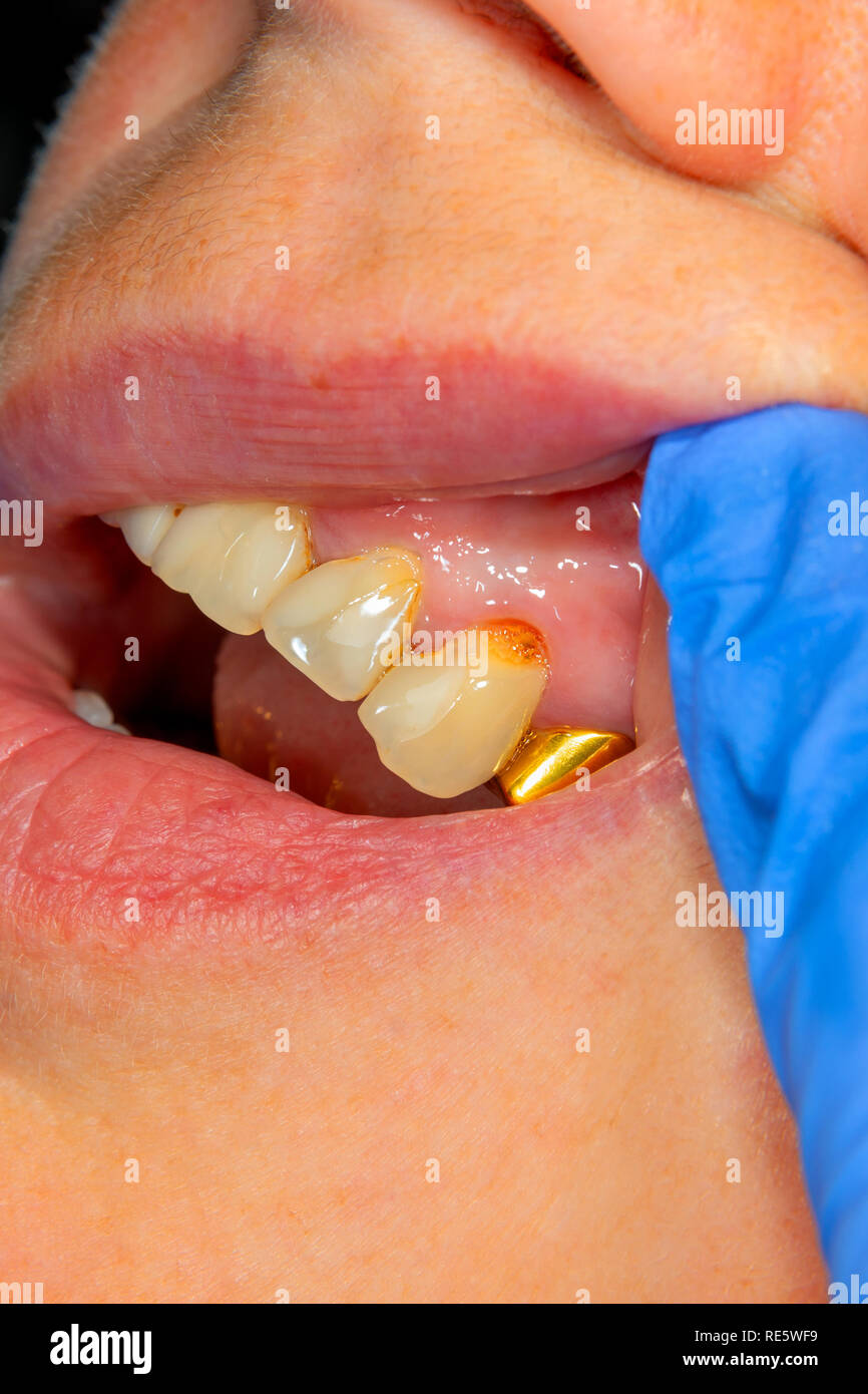 two chewing side teeth of the upper jaw after treatment of caries ...