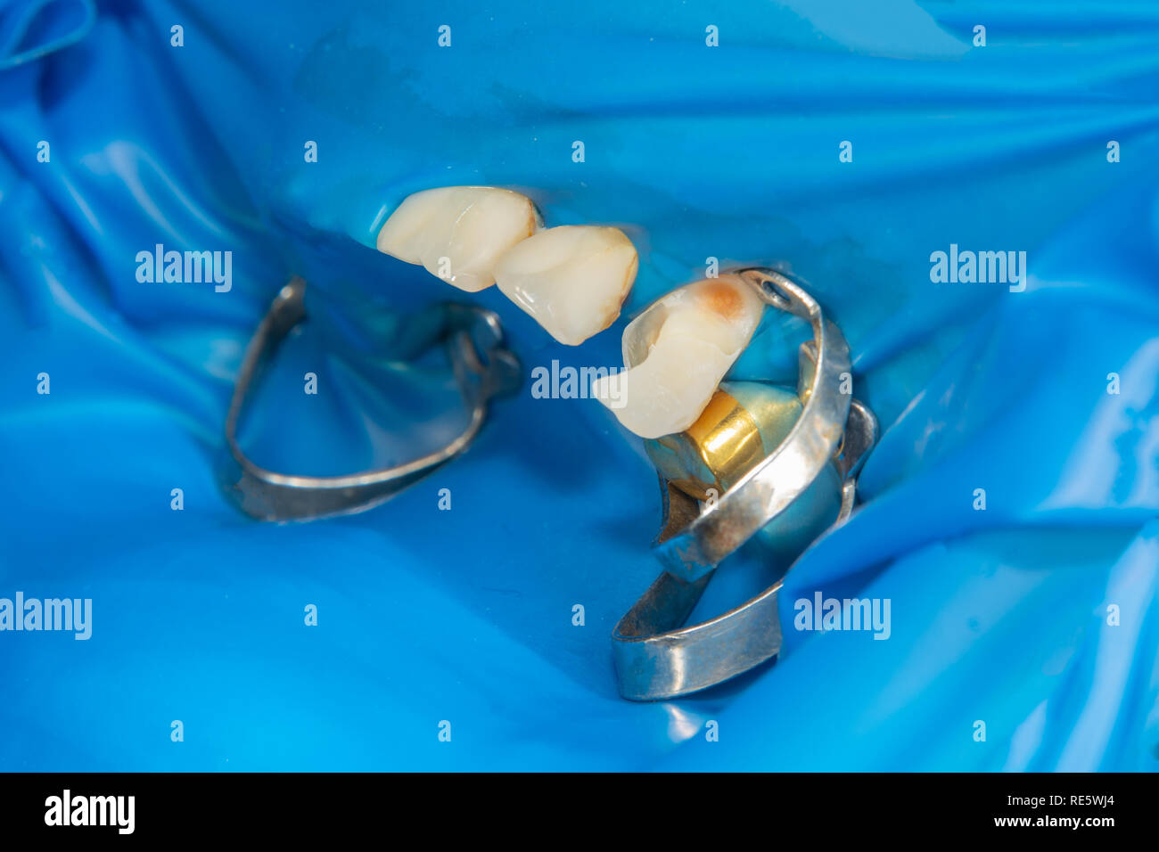 two chewing side teeth of the upper jaw after treatment of caries ...