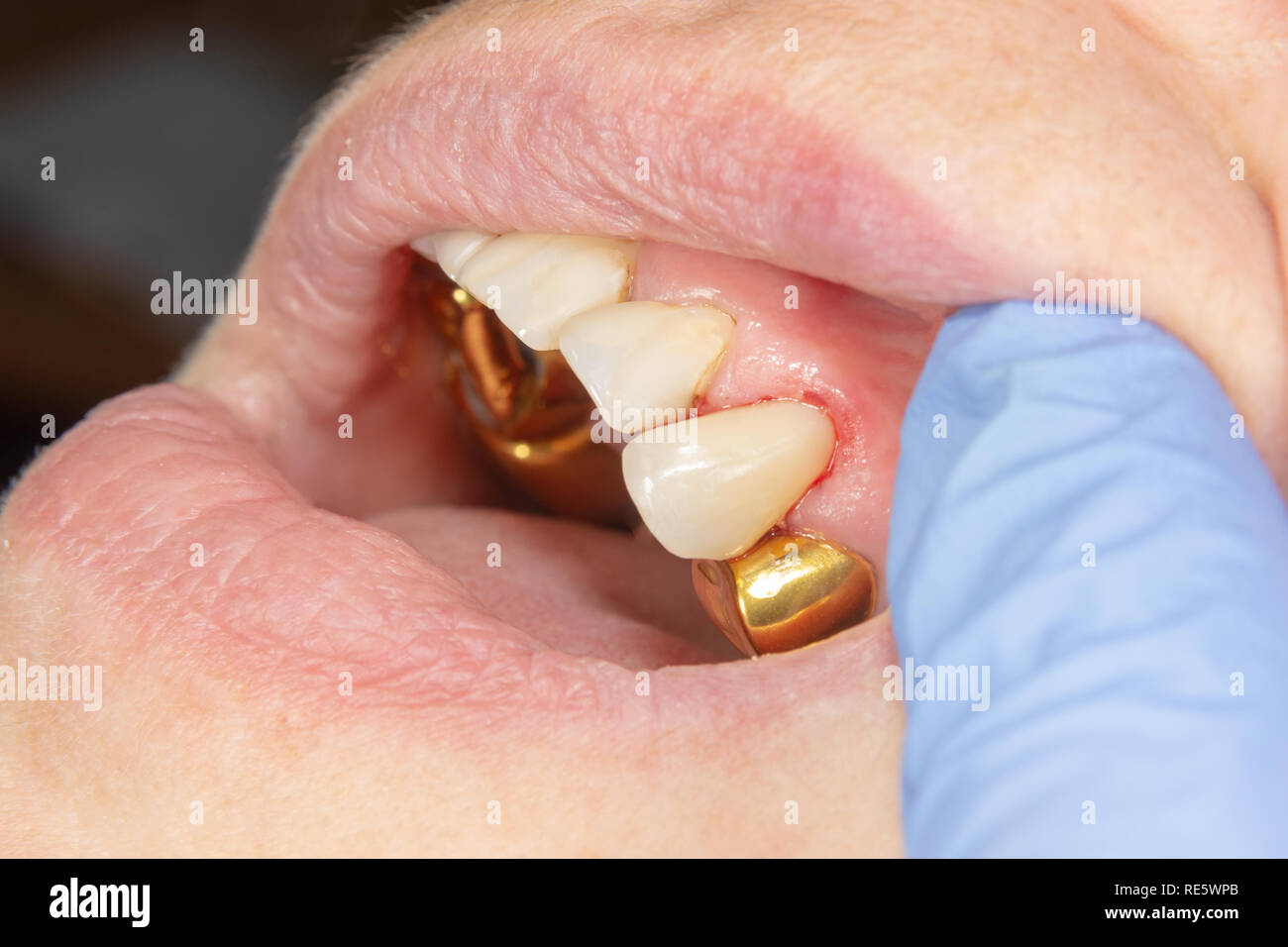 two chewing side teeth of the upper jaw after treatment of caries ...