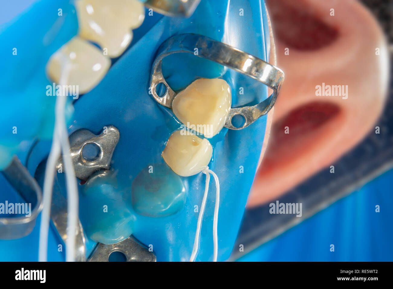 two chewing side teeth of the upper jaw after treatment of caries ...