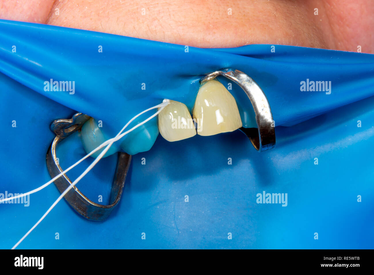 two chewing side teeth of the upper jaw after treatment of caries ...
