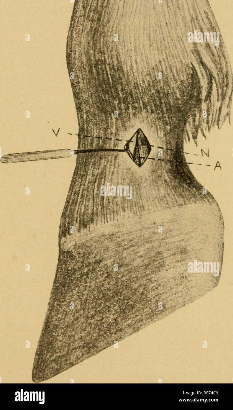 Neurectomy hi-res stock photography and images - Alamy
