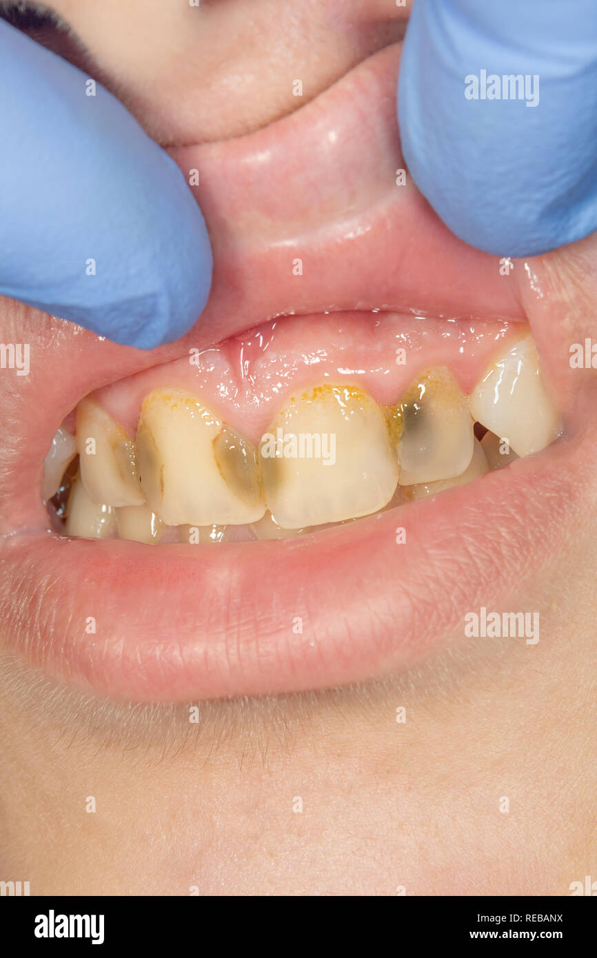 closeup treated human tooth in a dental filling rotten clinic.Cleaning ...