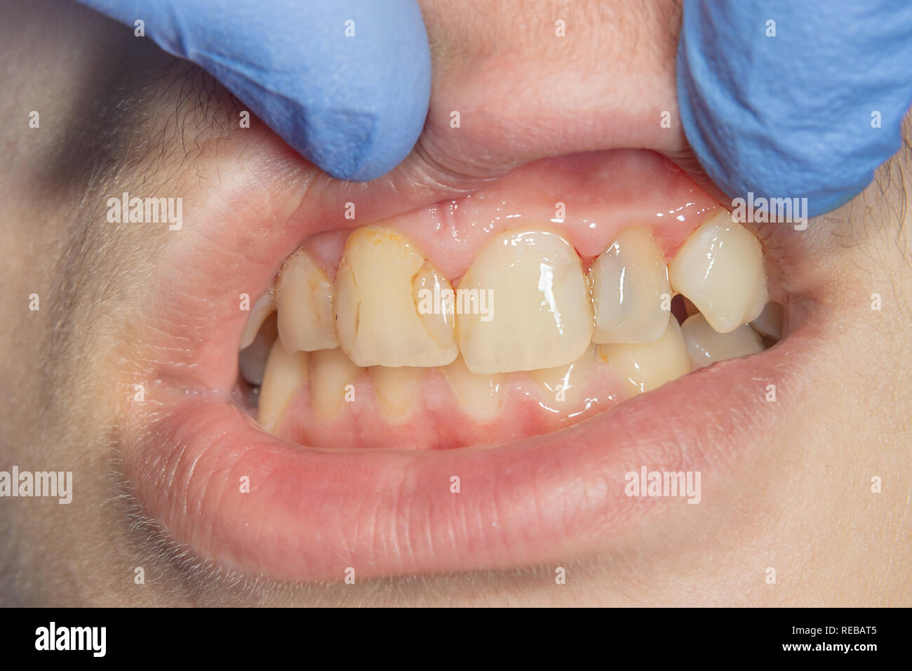 two chewing side teeth of the upper jaw after treatment of caries ...