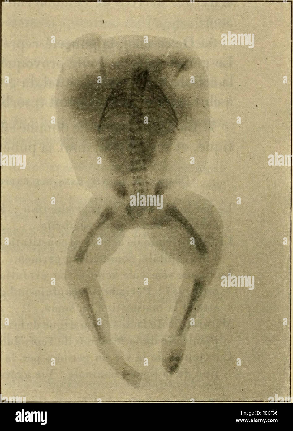 Moignons de bras hi-res stock photography and images - Alamy