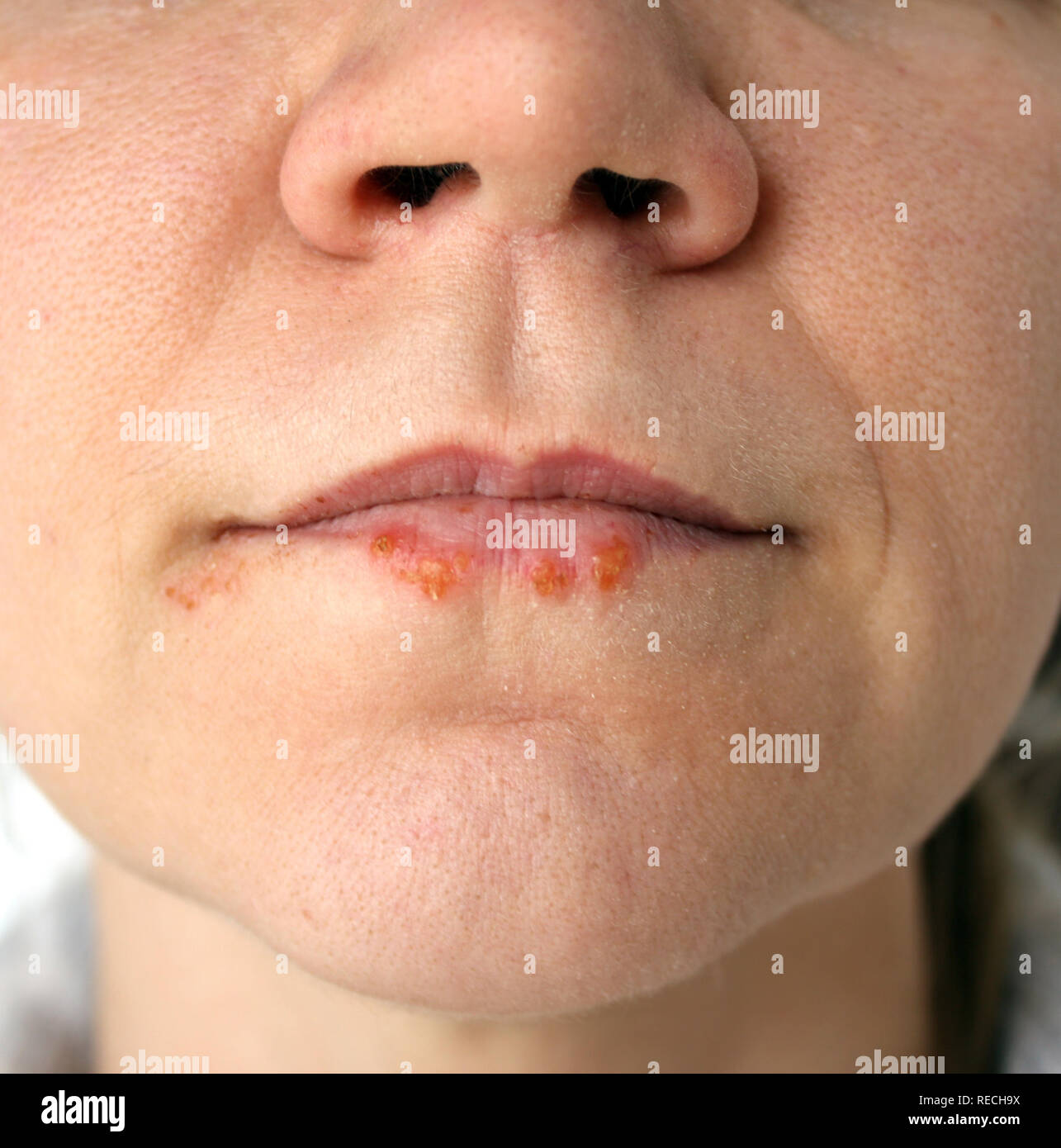 Cold sores hi-res stock photography and images - Alamy