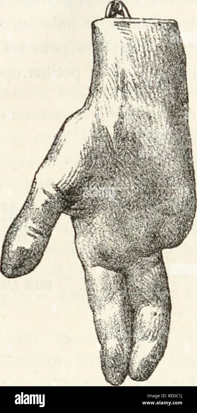 Amputation de la main hi-res stock photography and images - Alamy
