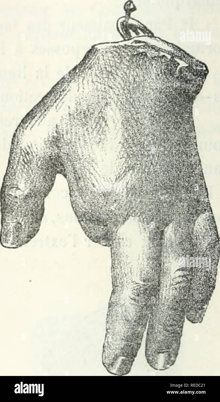 Amputation de la main hi-res stock photography and images - Alamy