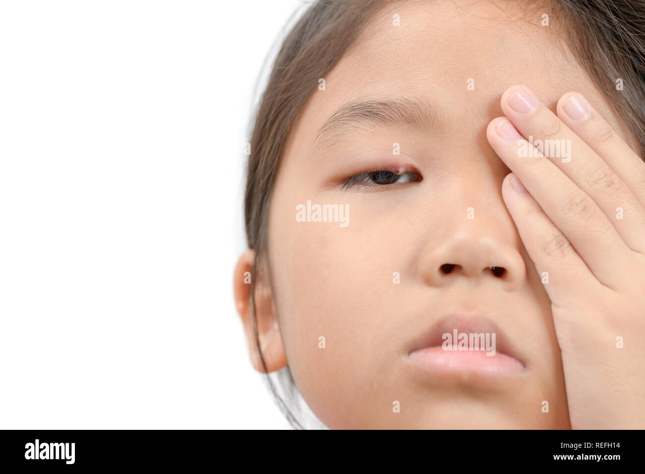 Close up of asian little girl one eye infection isolated on white ...