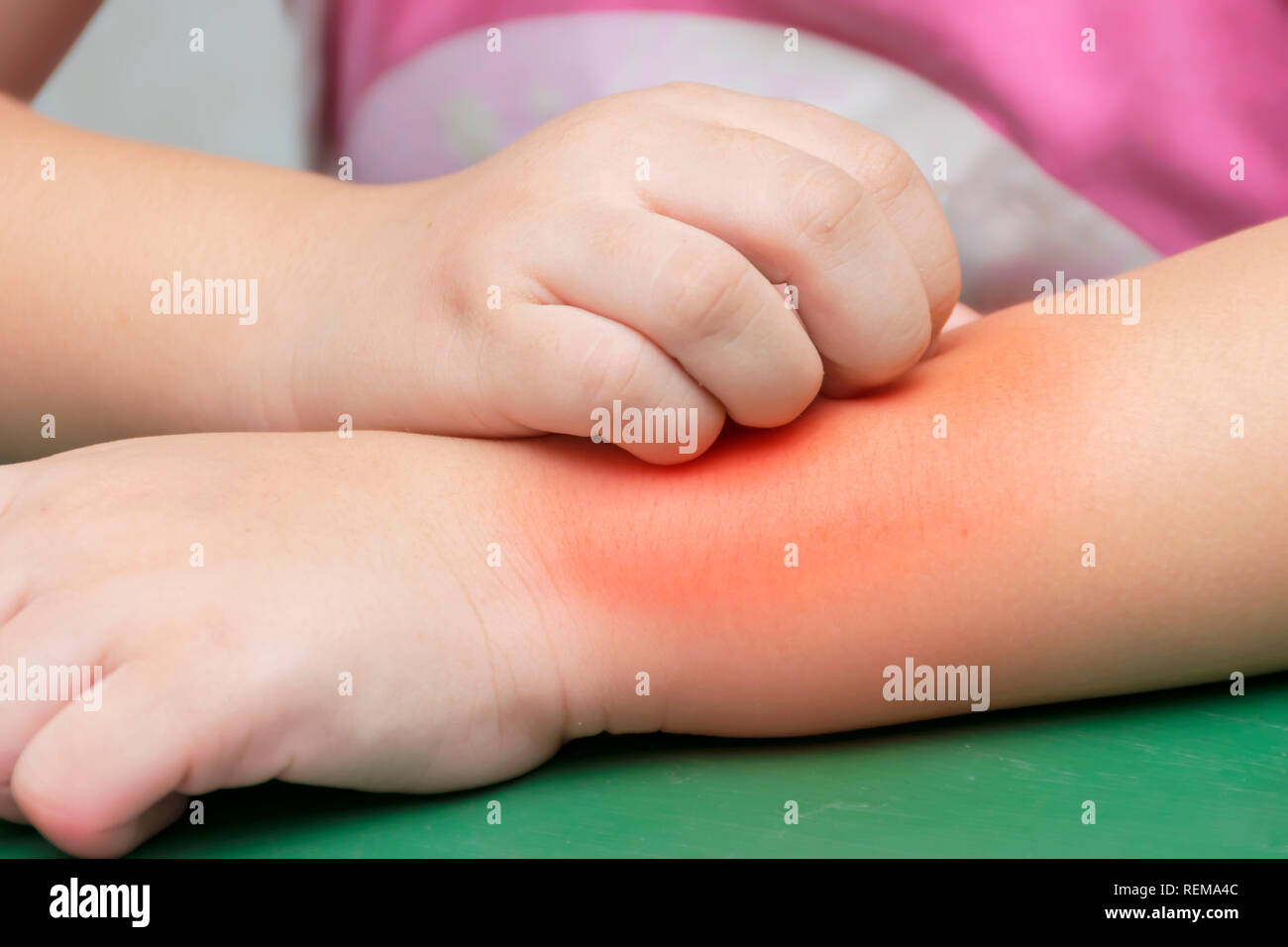 Allergies from mosquito bites. Children are scratching their arms ...