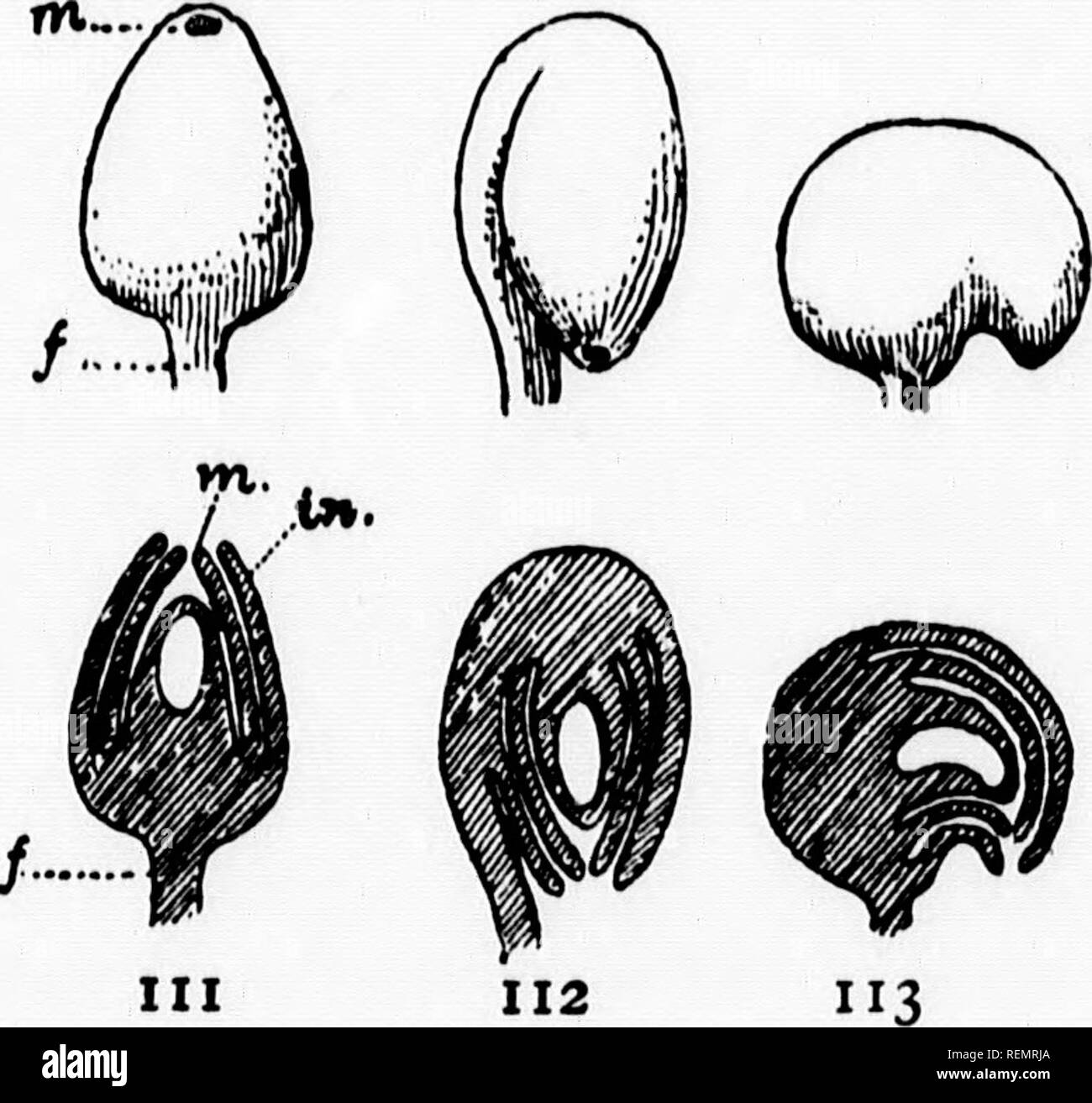Ring Shaped Placenta