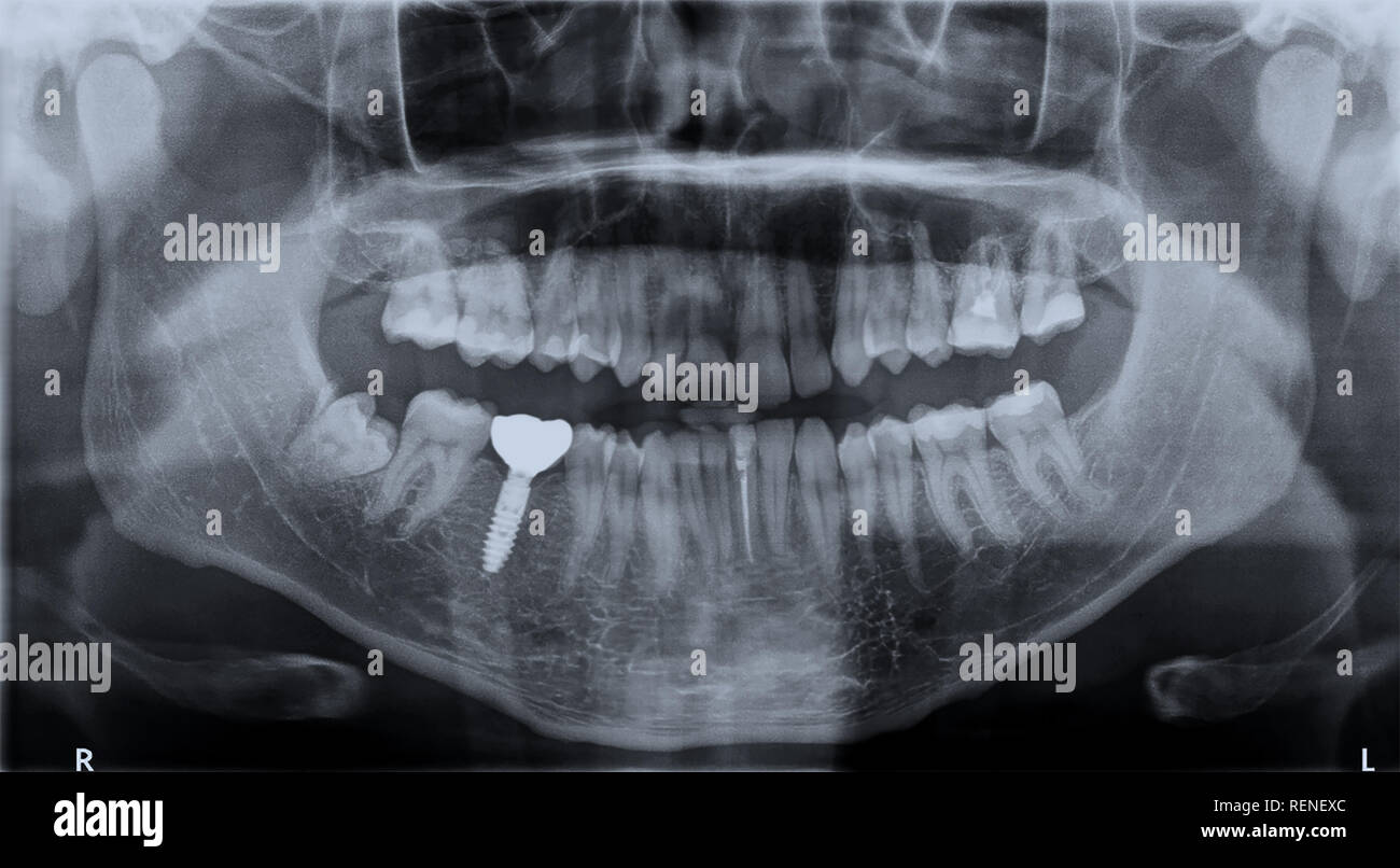 Panoramic black and white image dental x-ray of adult with single ...
