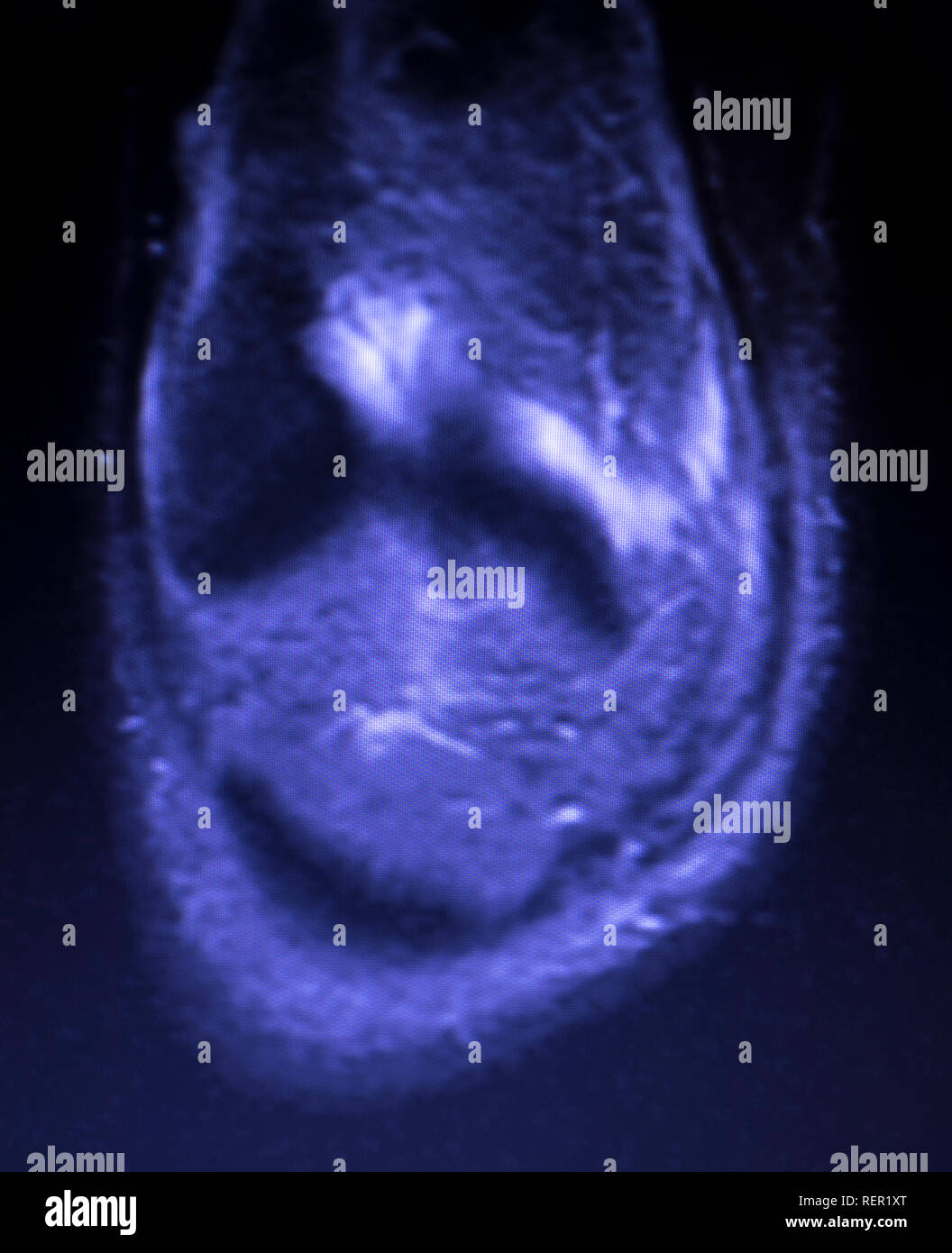 Magnetic resonance imaging MRI knee posterior horn medial meniscus tear ...