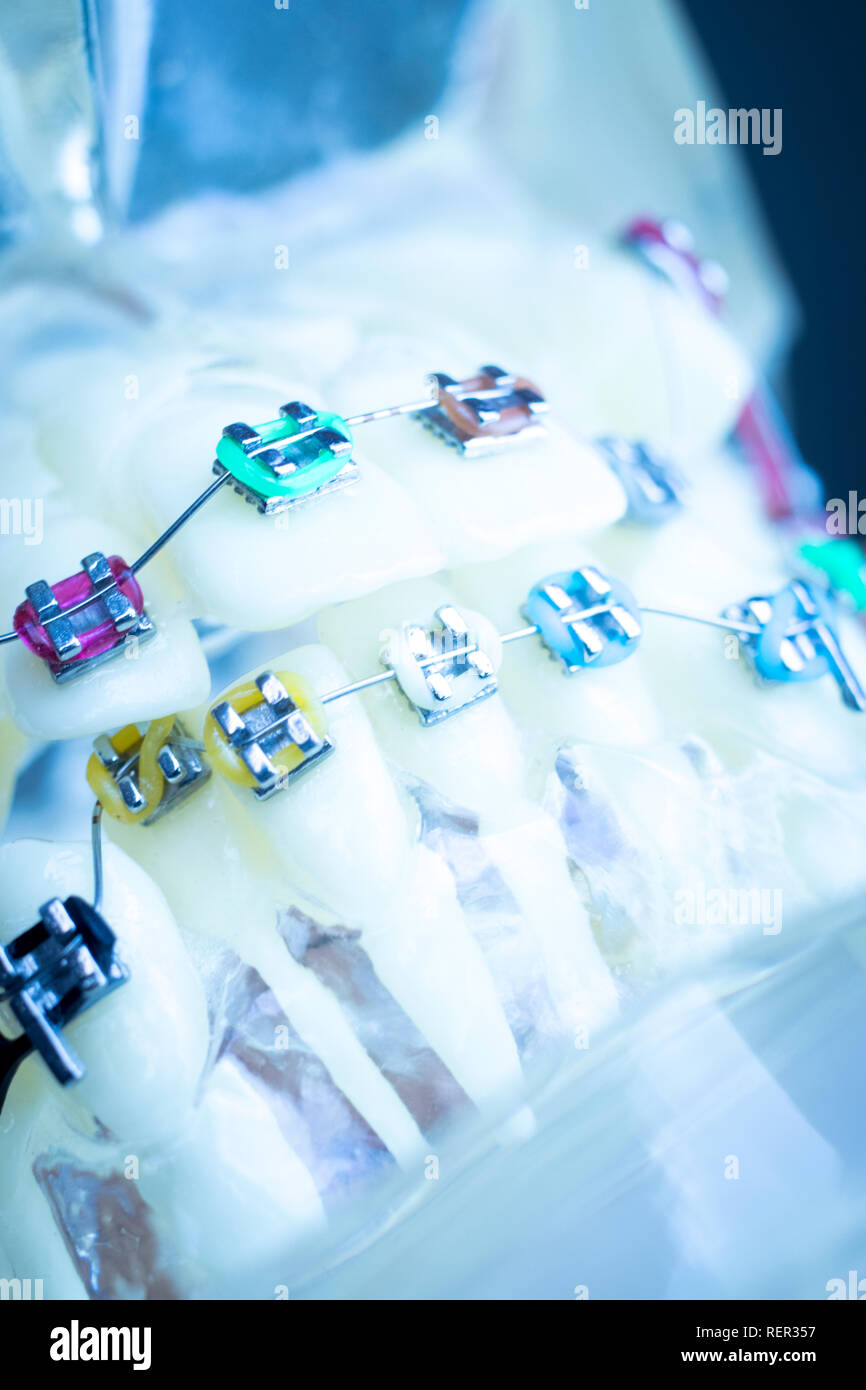 Dental metal braces teeth retainer aligners teaching orthodontics model ...