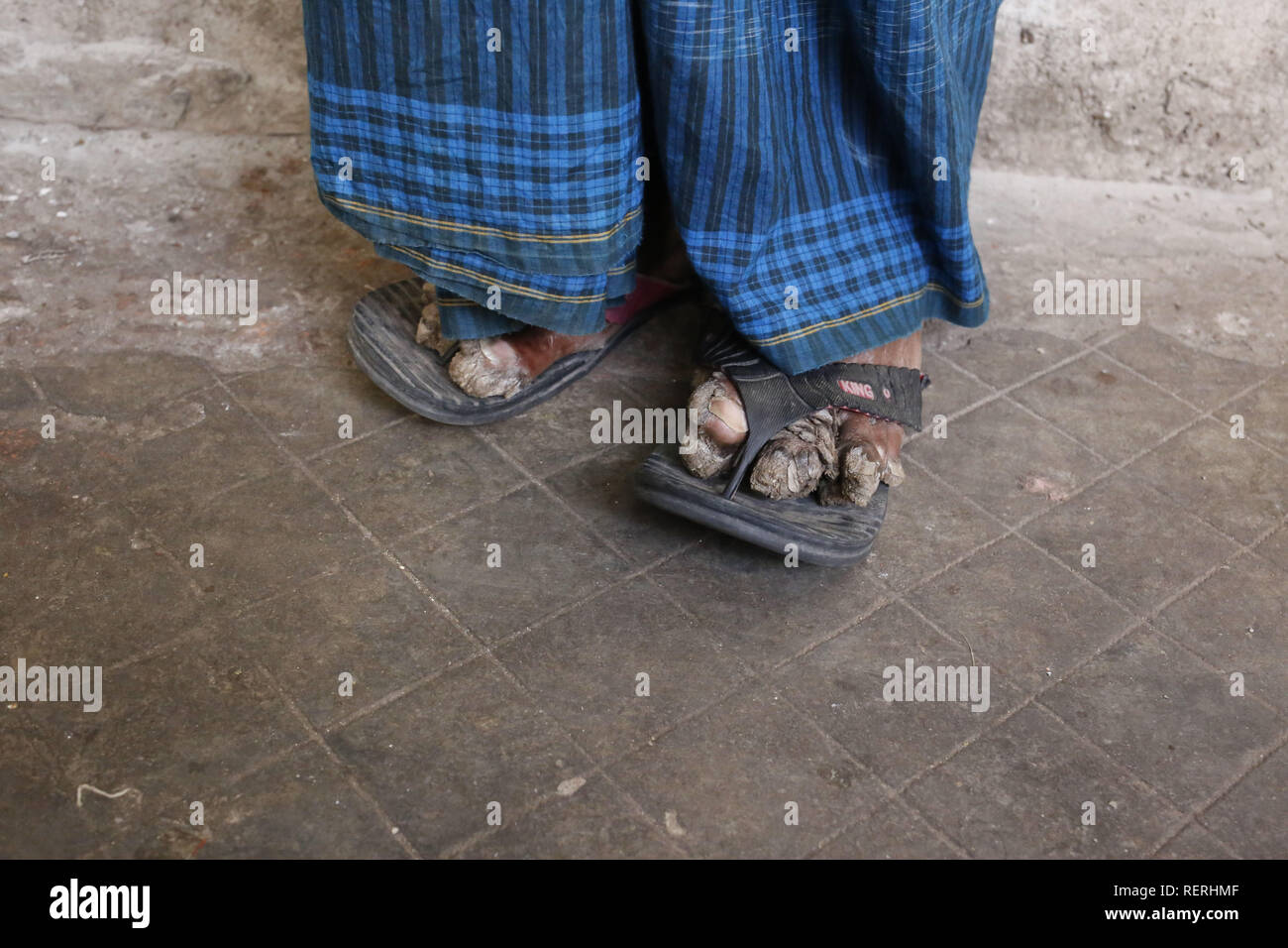 Tree man syndrome hi-res stock photography and images - Alamy