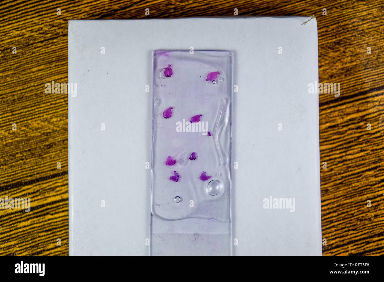 Slices of the tumor under glass. Histological examination of tumor ...
