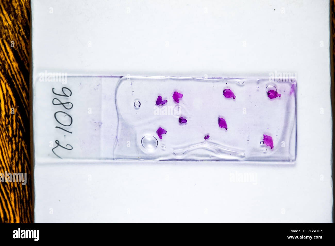 Slices of the tumor under glass. Histological examination of tumor ...