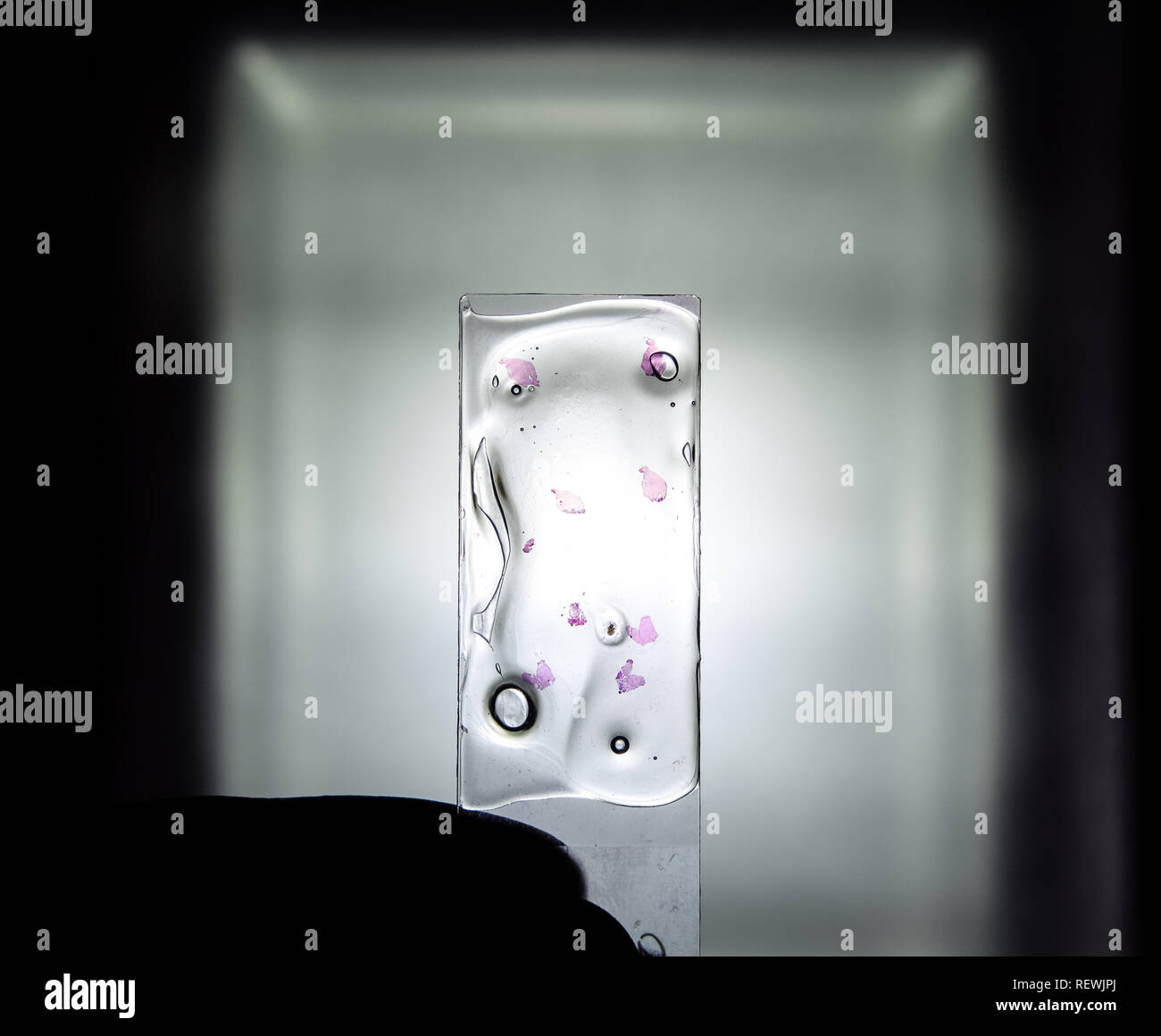 Slices of the tumor under glass. Histological examination of tumor ...