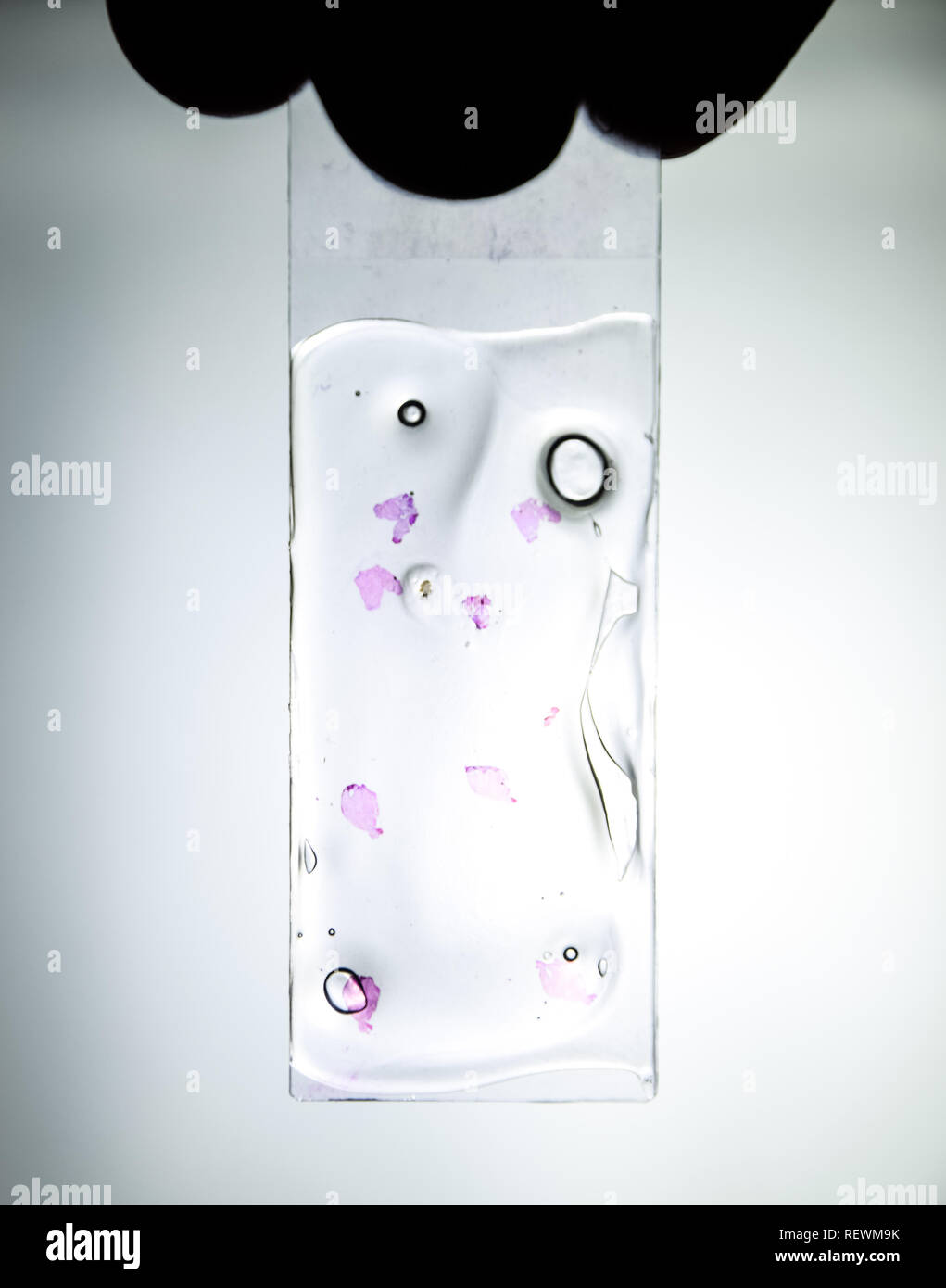 Slices of the tumor under glass. Histological examination of tumor ...