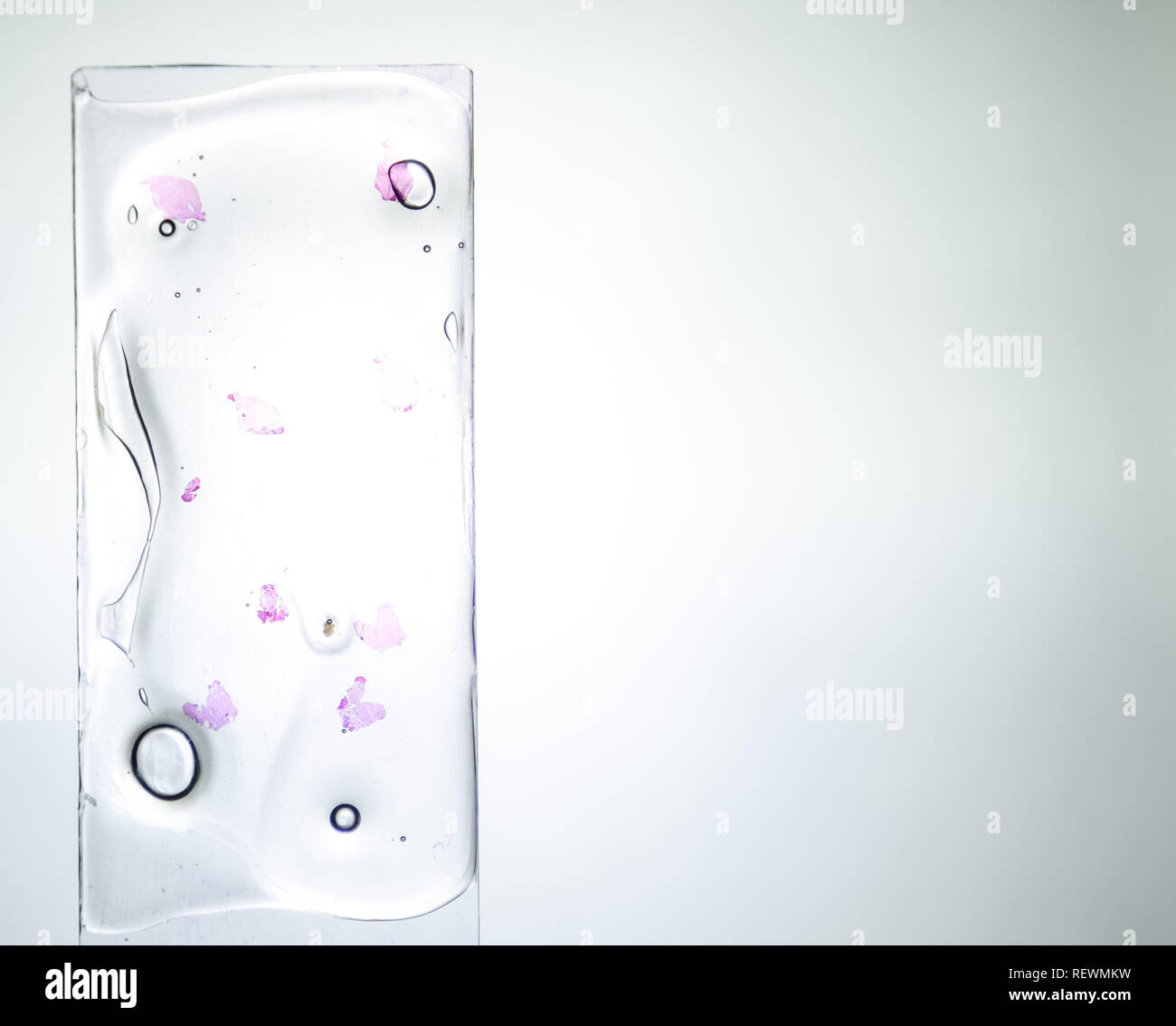 Slices of the tumor under glass. Histological examination of tumor ...