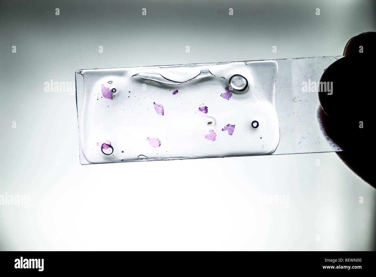Slices of the tumor under glass. Histological examination of tumor ...