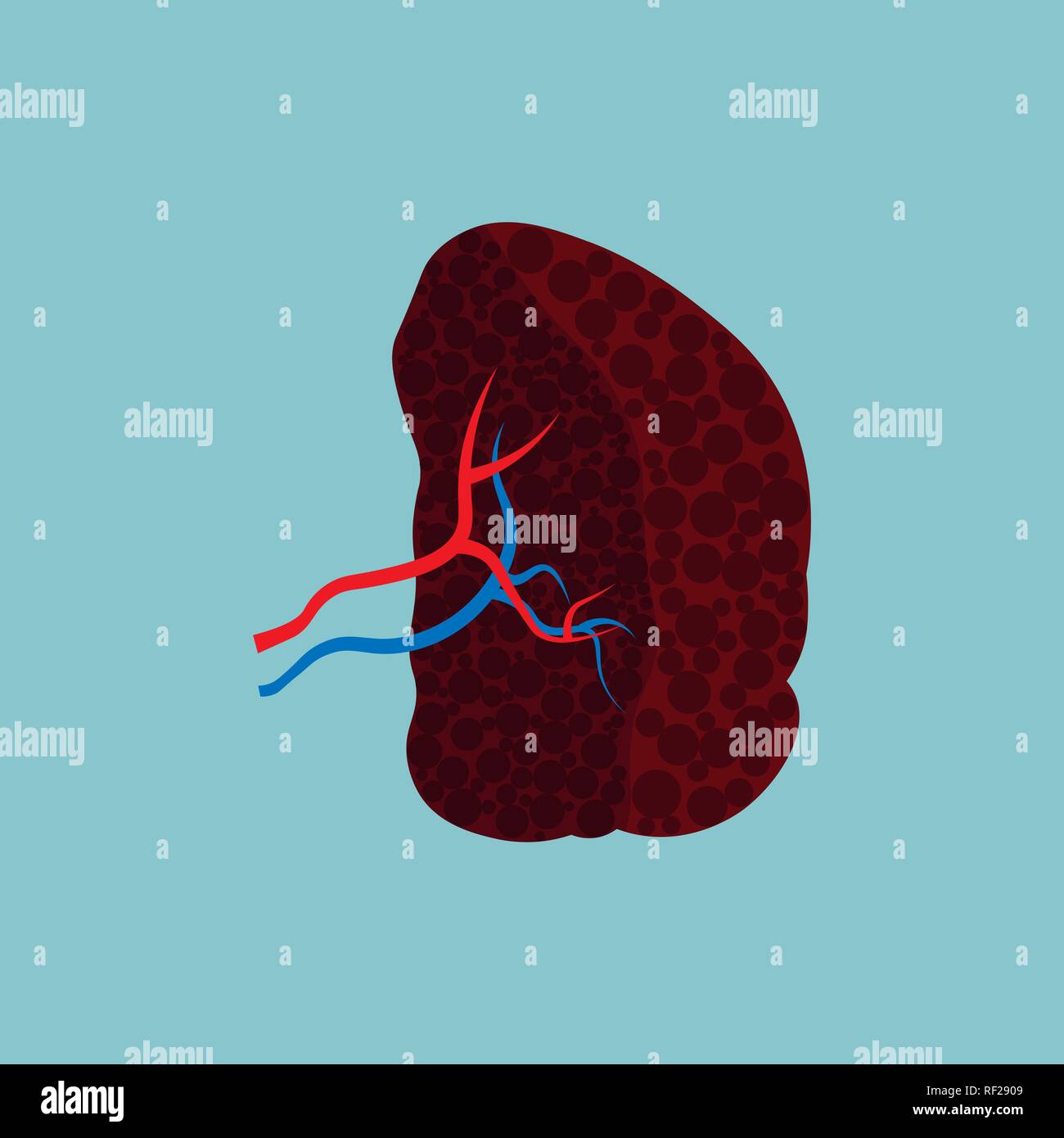 Medical illustration of diseases of the spleen, abscess, cysts, rupture ...
