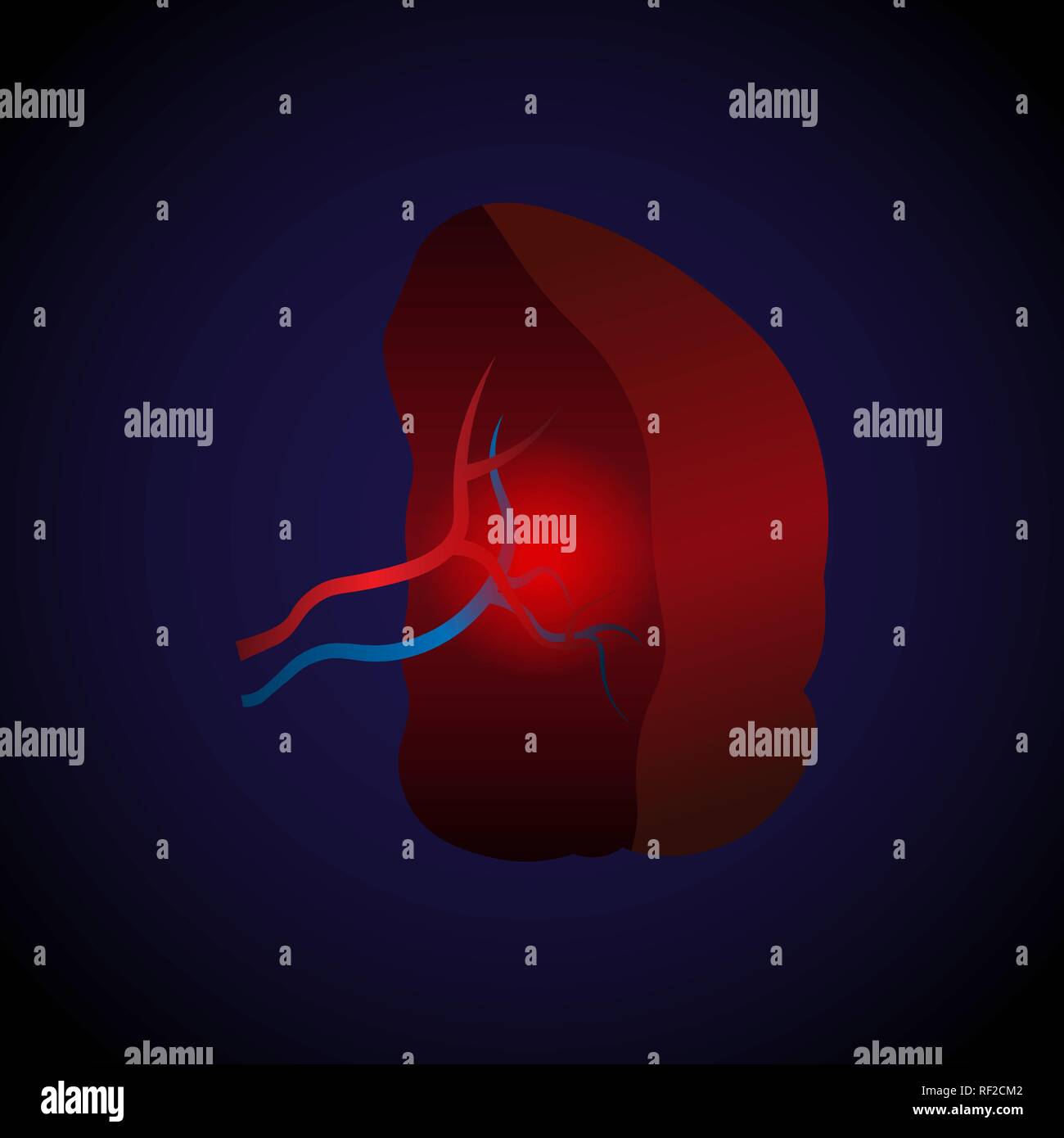 medical illustration of spleen disease with a pain point, abscess ...