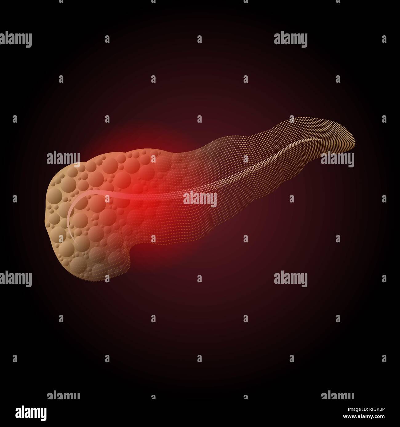 Pancreatitis. Medical illustration of diseases of the pancreas of a ...