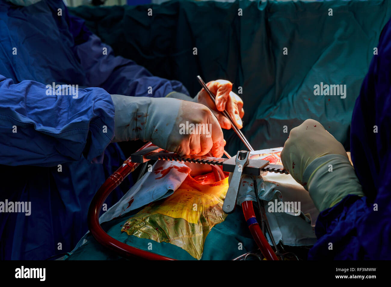 A surgeon performs coronary artery bypass grafting open heart surgery ...