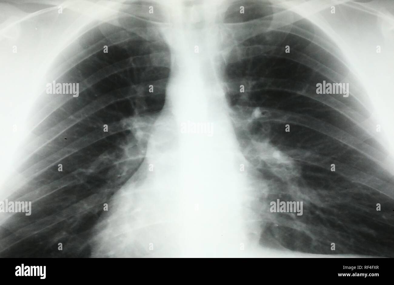 Human Lung X-ray image Stock Photo - Alamy