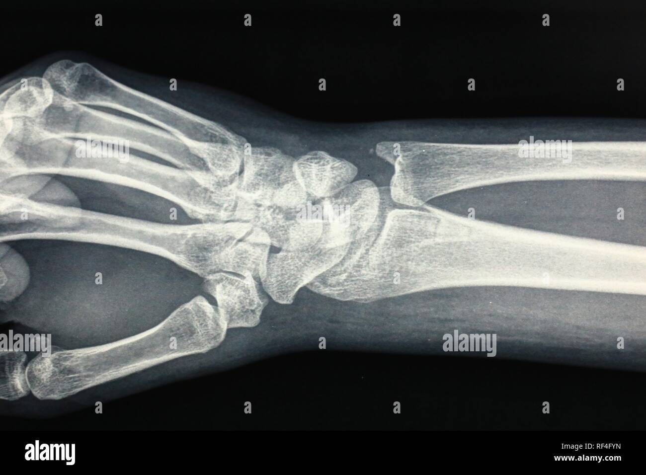 Human hand and wrist x-ray image Stock Photo - Alamy