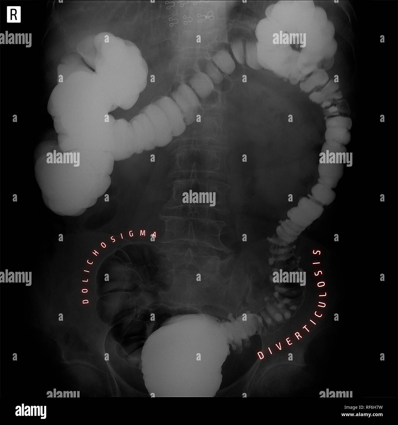 Lower gi tract hi-res stock photography and images - Alamy