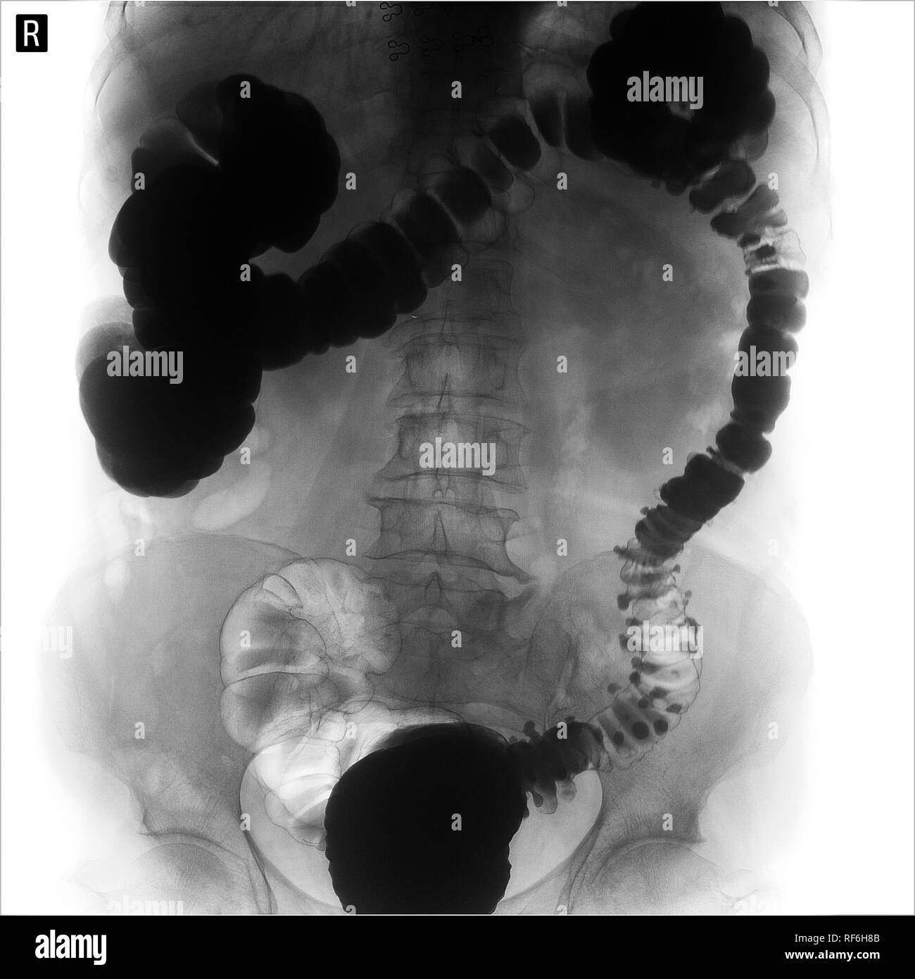 Colon spleen hi-res stock photography and images - Alamy