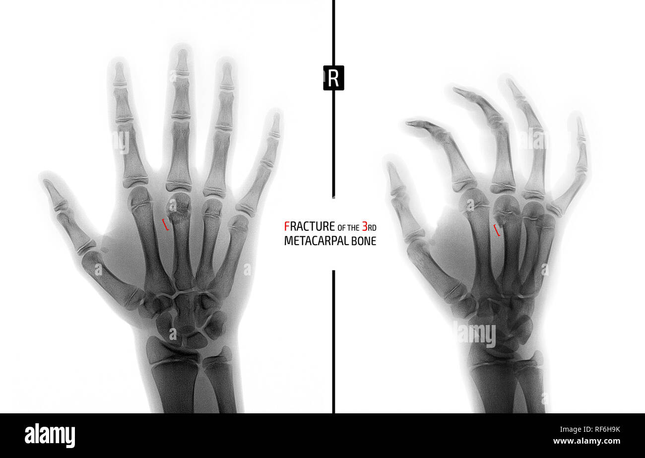 Child skeleton x ray hi-res stock photography and images - Alamy