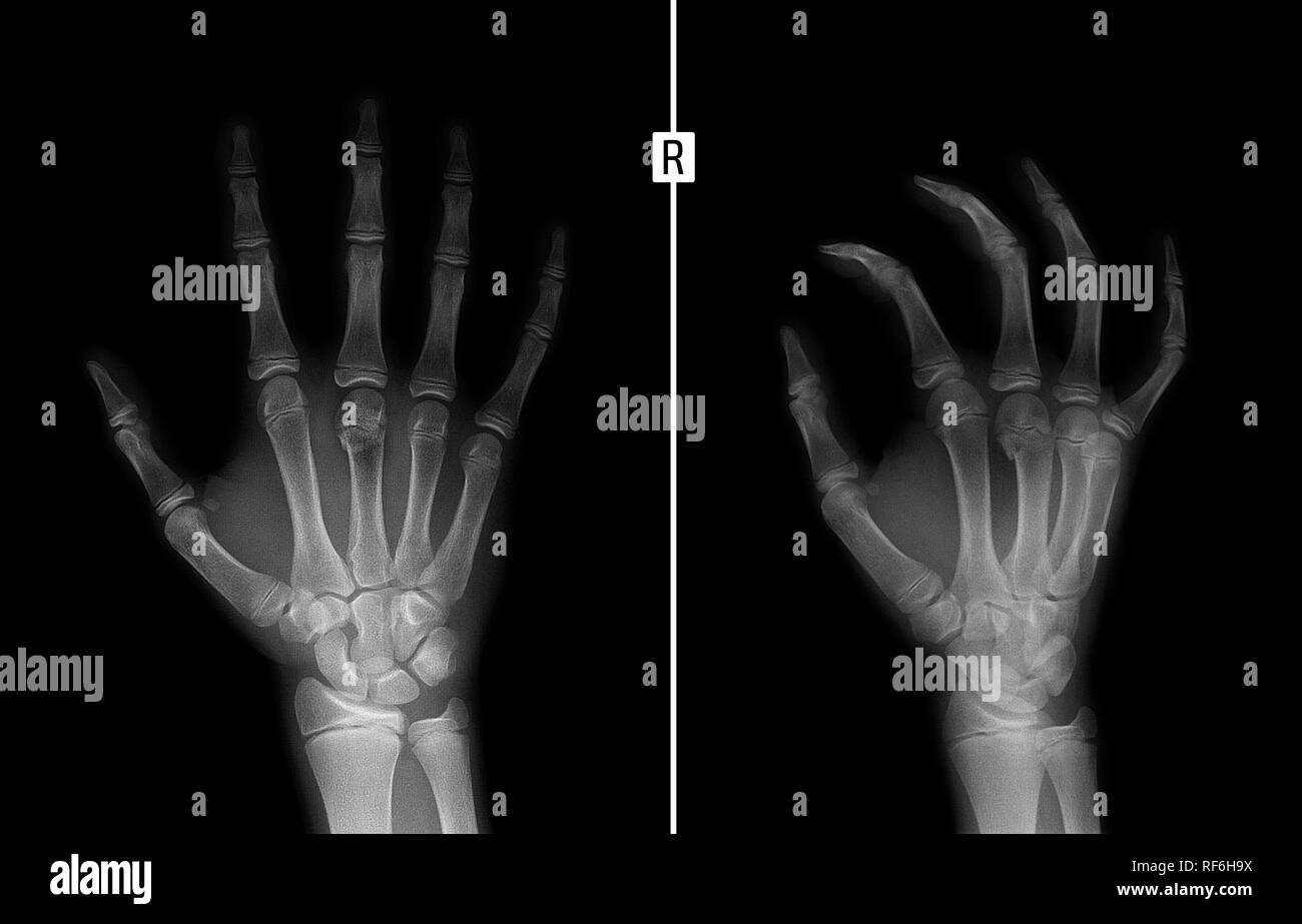 Forearm fracture hi-res stock photography and images - Alamy