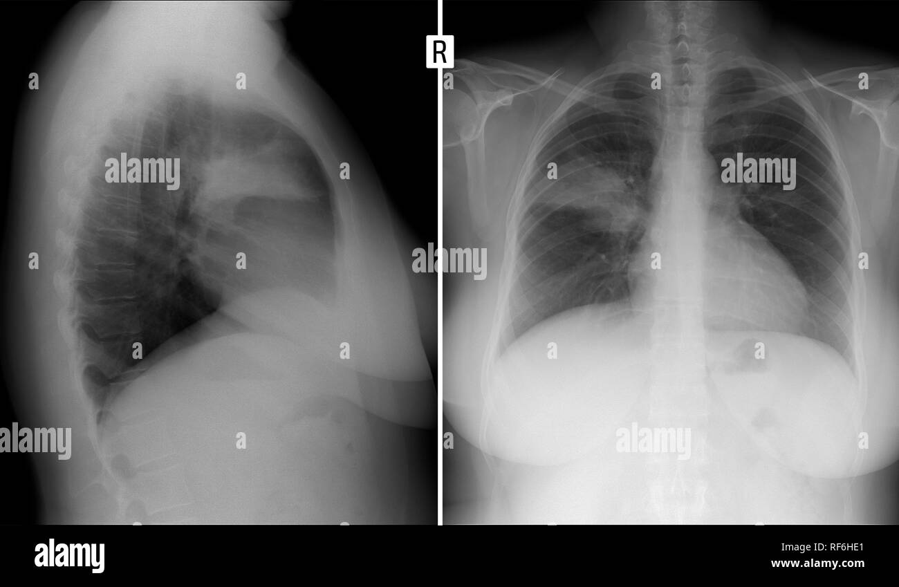 Bronchiectasis hi-res stock photography and images - Alamy