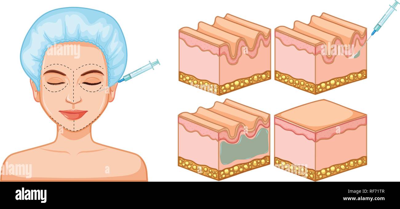 Lady facial and skin botox illustration Stock Vector Image & Art - Alamy