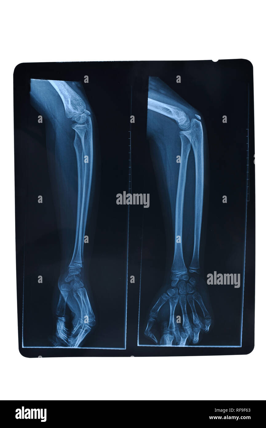 x-ray of forearm isolated on white background Stock Photo - Alamy