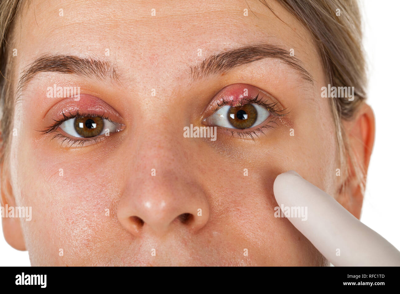 Close Up Picture Of Female Patients Infected Eye Hordeolum On Upper Eyelid Viral Infection