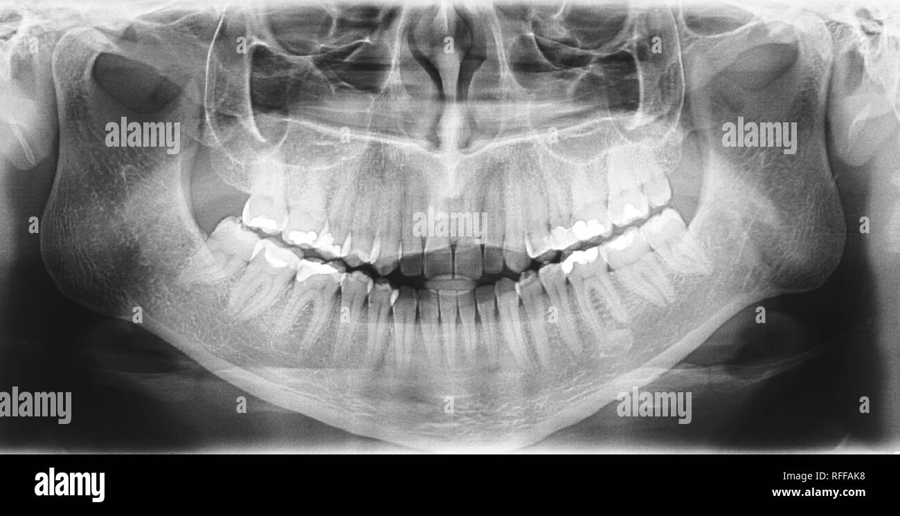 X-ray scan of humans teeth Stock Photo - Alamy