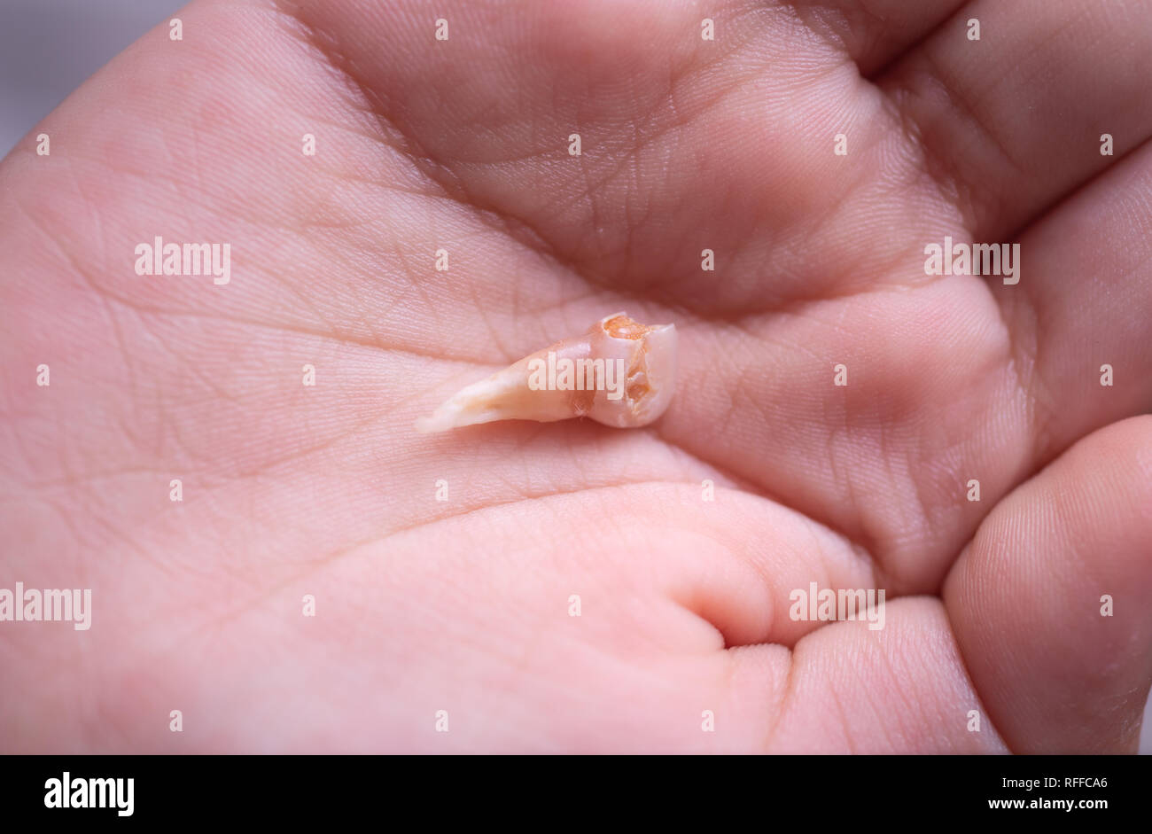 Loose tooth hi-res stock photography and images - Alamy