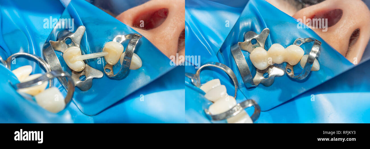 filling and restoration of tooth loss with adhesive composite material ...