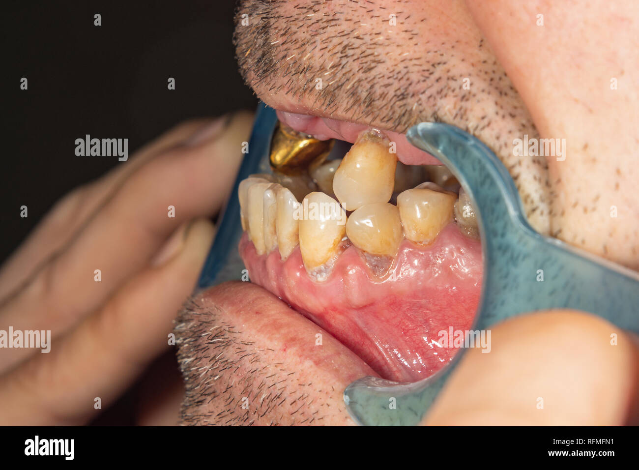 patient's bad teeth at the dentist's dentist close-up macro. Caries ...