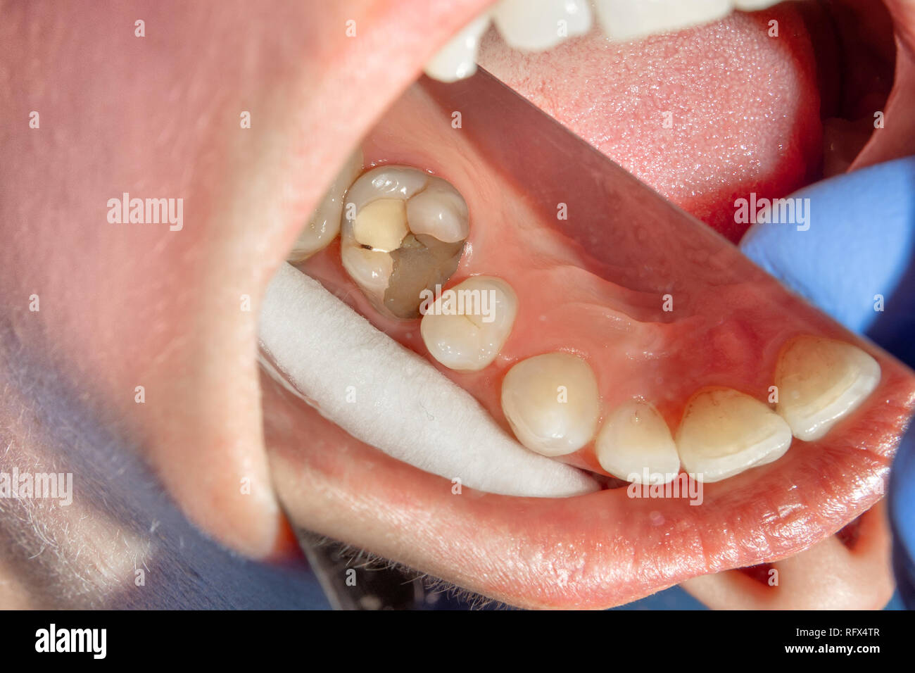 two chewing side teeth of the upper jaw after treatment of caries ...