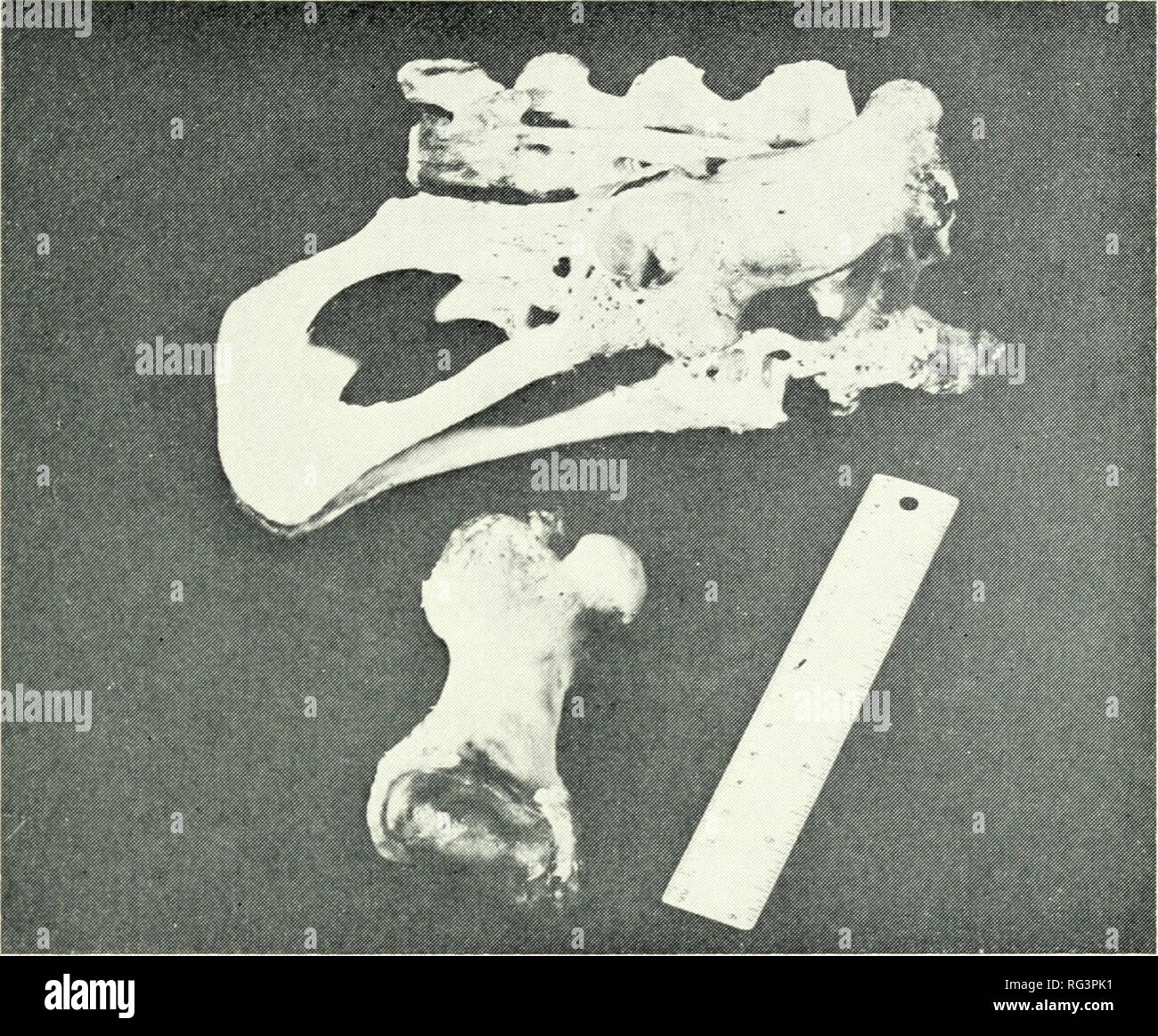 Tuberculosis effect on bone hi-res stock photography and images - Alamy