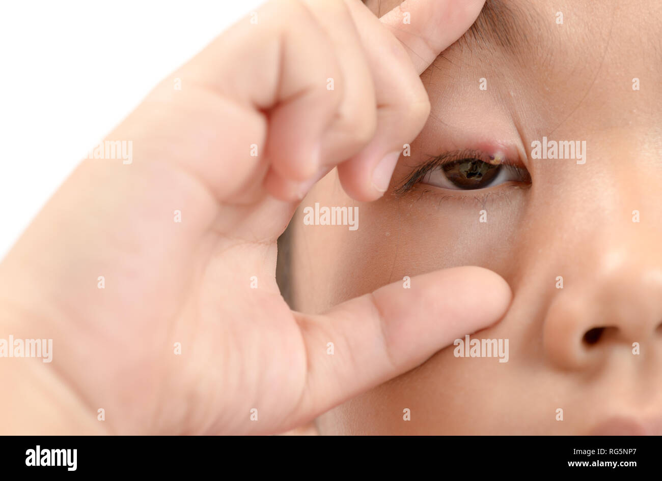 Close up of asian little girl one eye infection isolated on white ...