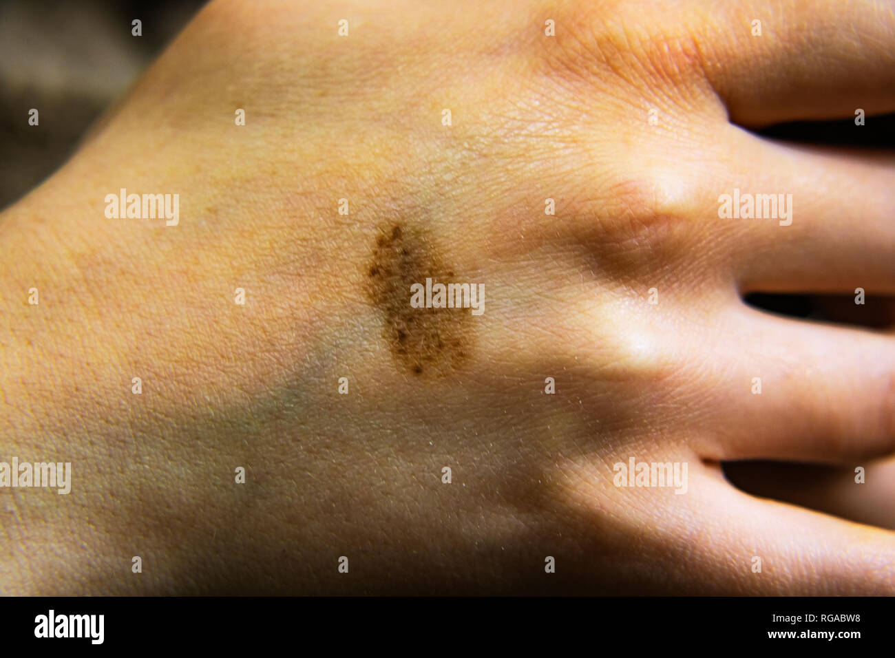 Woman skin cancer mole hi-res stock photography and images - Alamy