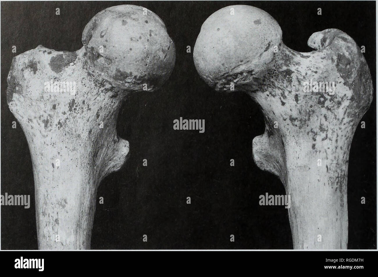 Medial supracondylar ridge hi-res stock photography and images - Alamy